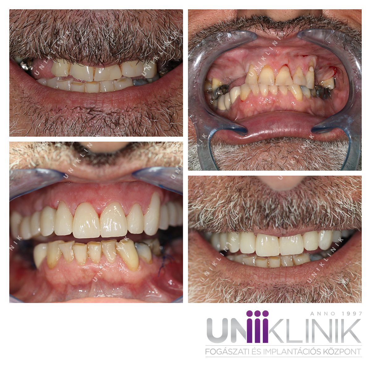 Cirkon korona: a porcelántól a full cirkon koronáig | Uniklinik.hu ...