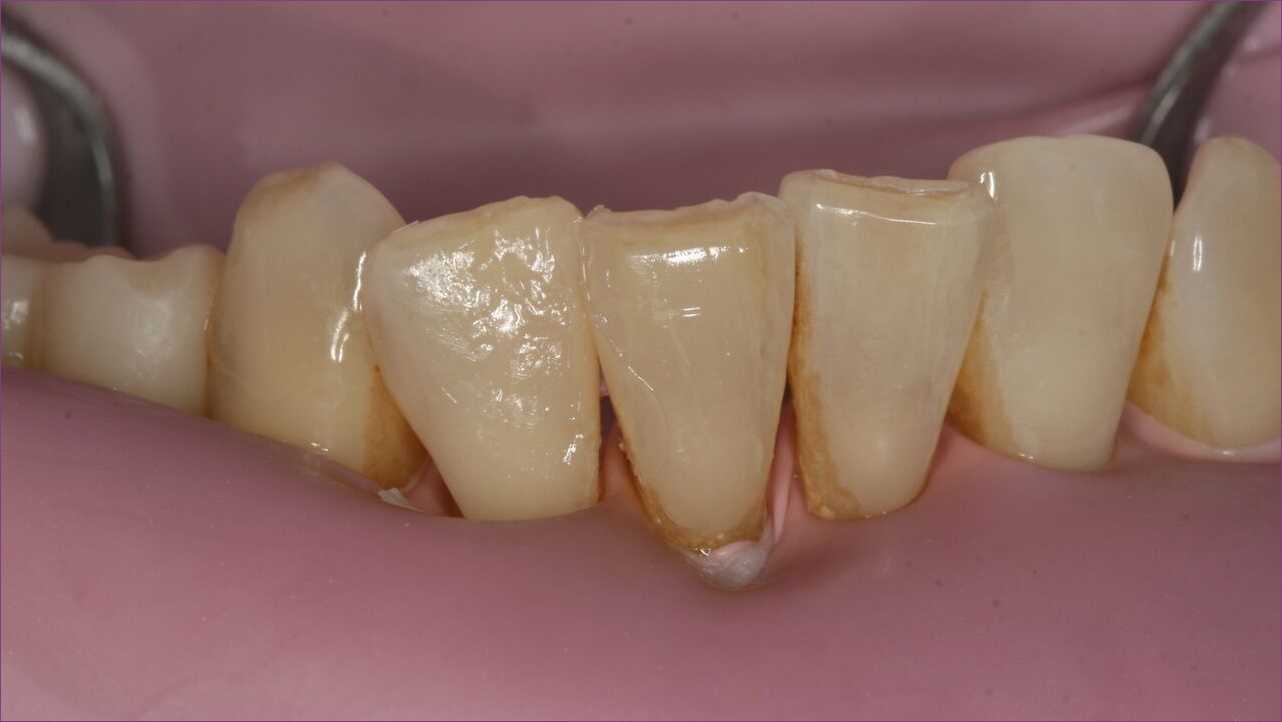 Fogszuvasodás kezelése láthatatlan töméssel | Uniklinik.hu - Együtt a ...