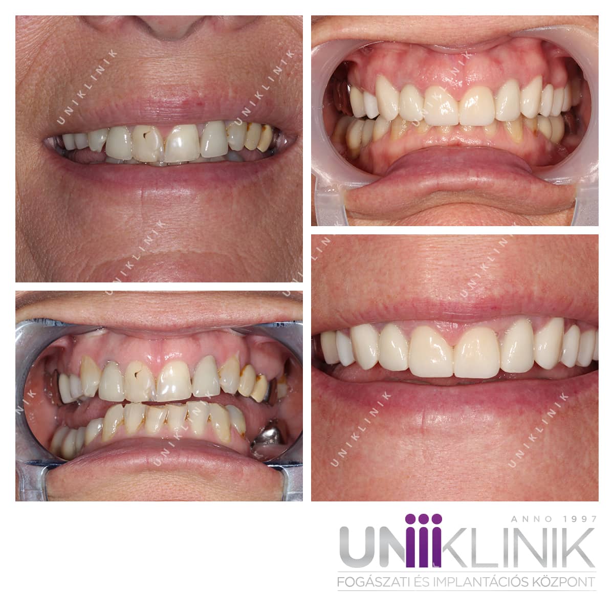 Magas esztétikájú full cirkon koronák felső fogakon