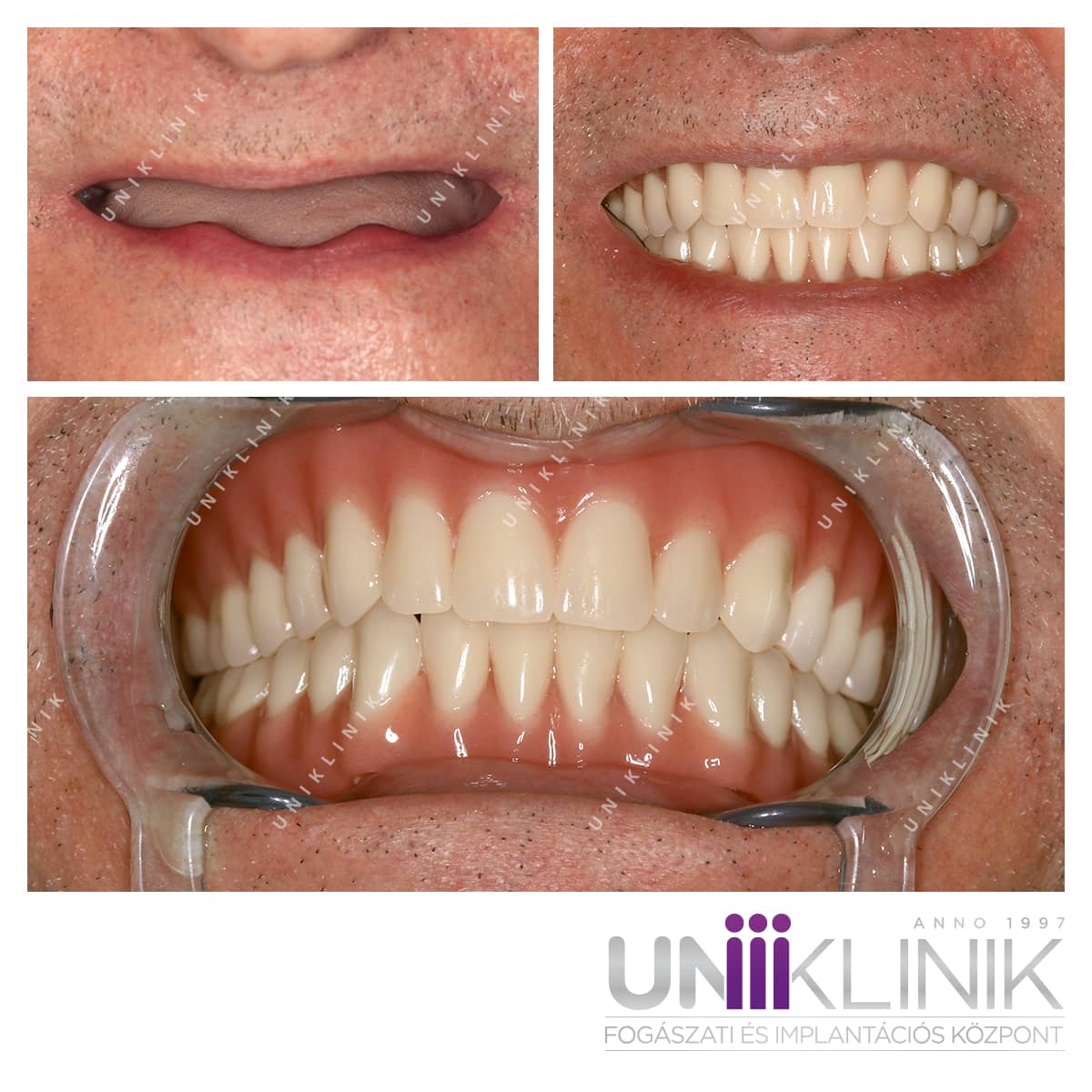 Teleszkópos fogsor, a saját fogakra rögzített protézis