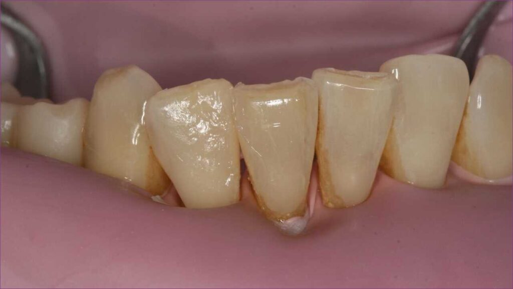 Fogszuvasodás kezelése láthatatlan kompozittöméssel - Uniklinik ...