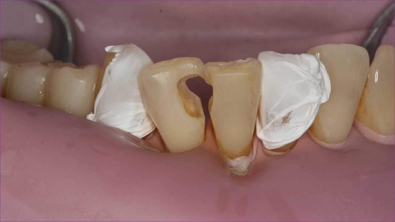 Fogszuvasodás kezelése láthatatlan töméssel