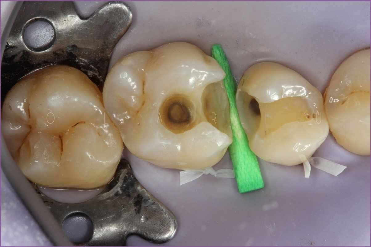 Fogtömés menete szakszerűen: a fogtömés anyagairól és típusairól