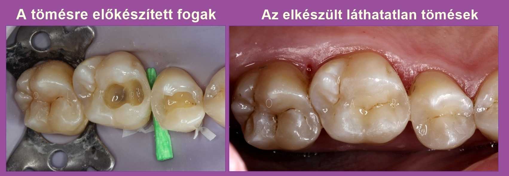 Mi a láthatatlan fogtömés lényege?