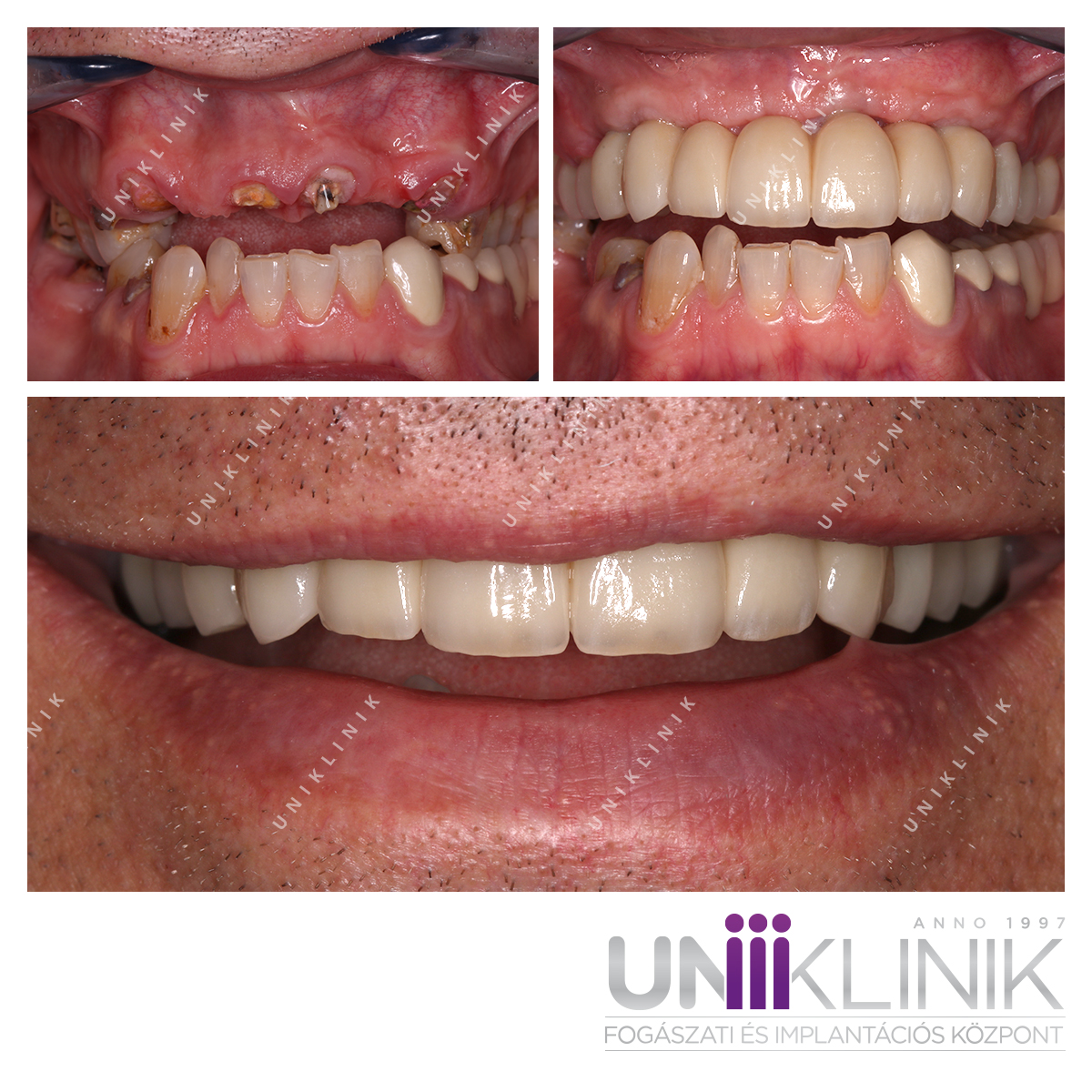 Cirkónium körhíd implantátumokon és saját fogakon