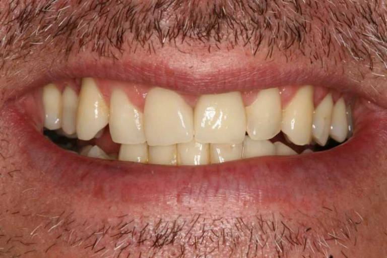 Letört fog pótlása - milyen lehetőségei vannak? - Uniklinik Fogászati ...