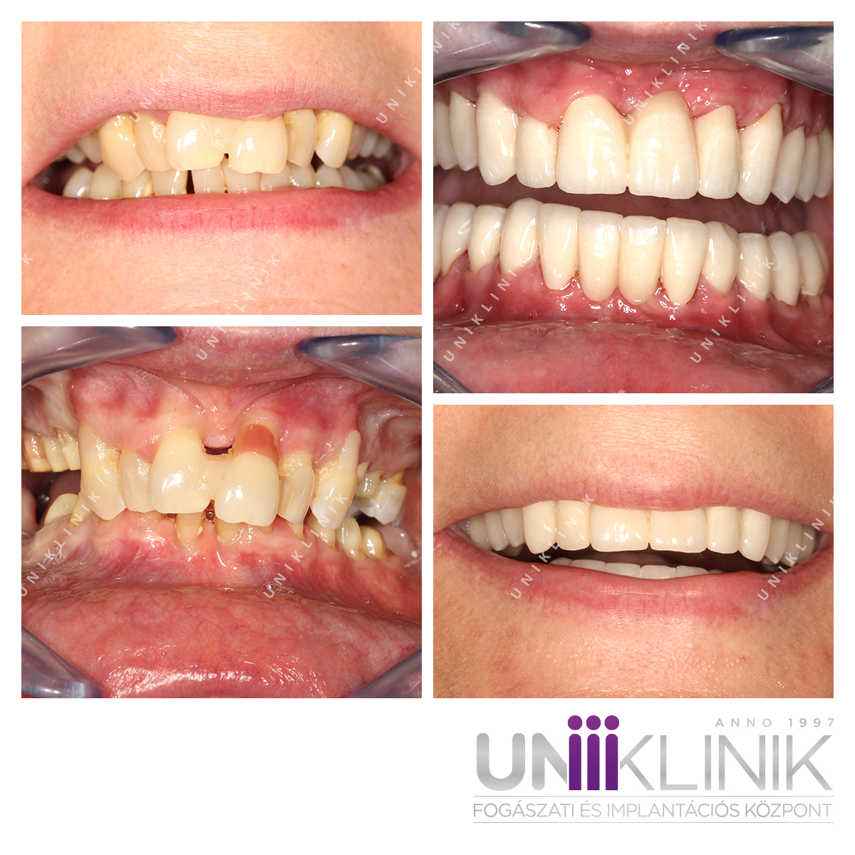 Implantátum nélküli teljes rehabilitáció - Fogágybetegség gyógyítása ...